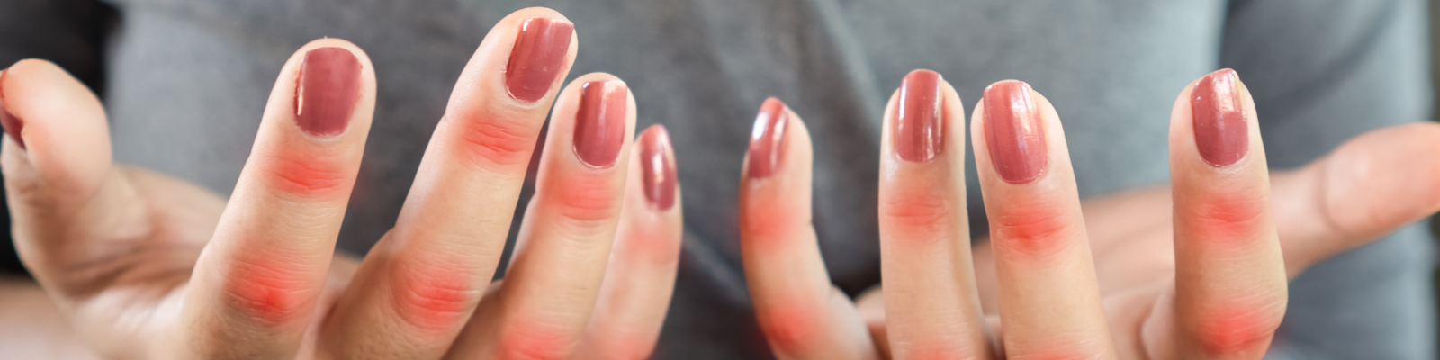 Qué son las calcificaciones y cómo afectan a las articulaciones ...