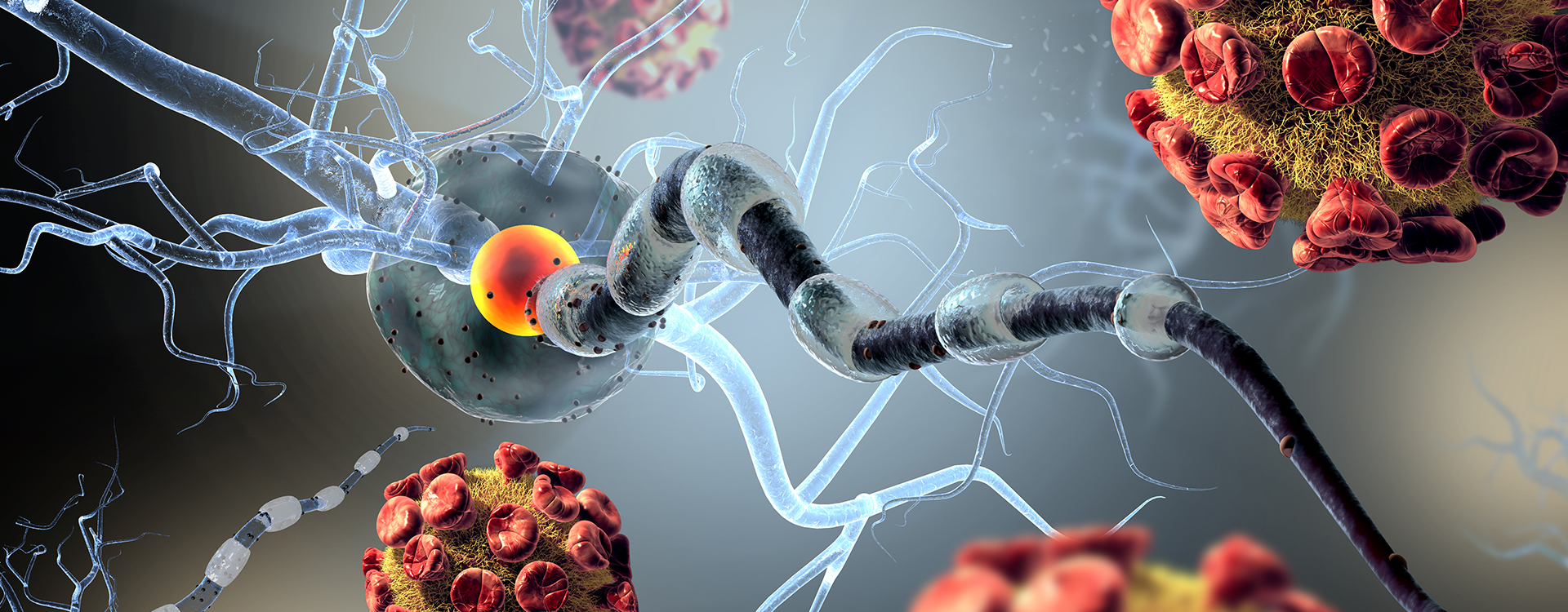 » Esclerosis múltiple: Causas, síntomas y tratamiento fisioterapéutico ...