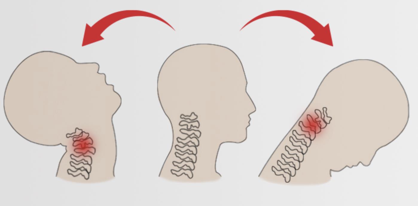 Qué sucede cuando tienes un esguince cervical por un accidente de ...